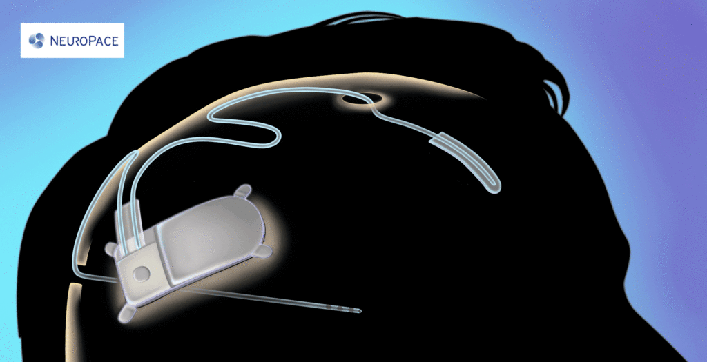 NeuroPace RNS: nuova cura per l'epilessia farmaco-resistente ...