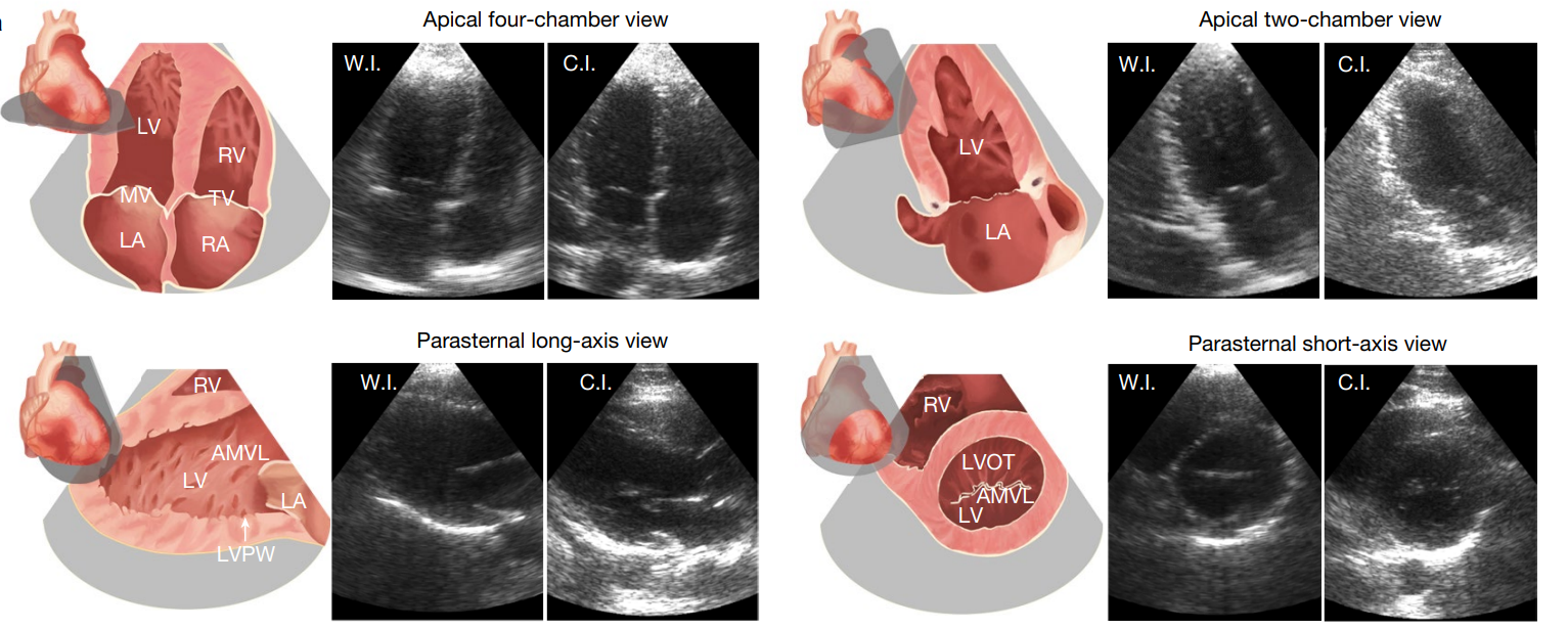 Un cerotto hi-tech ad ultrasuoni monitora il cuore in tempo reale