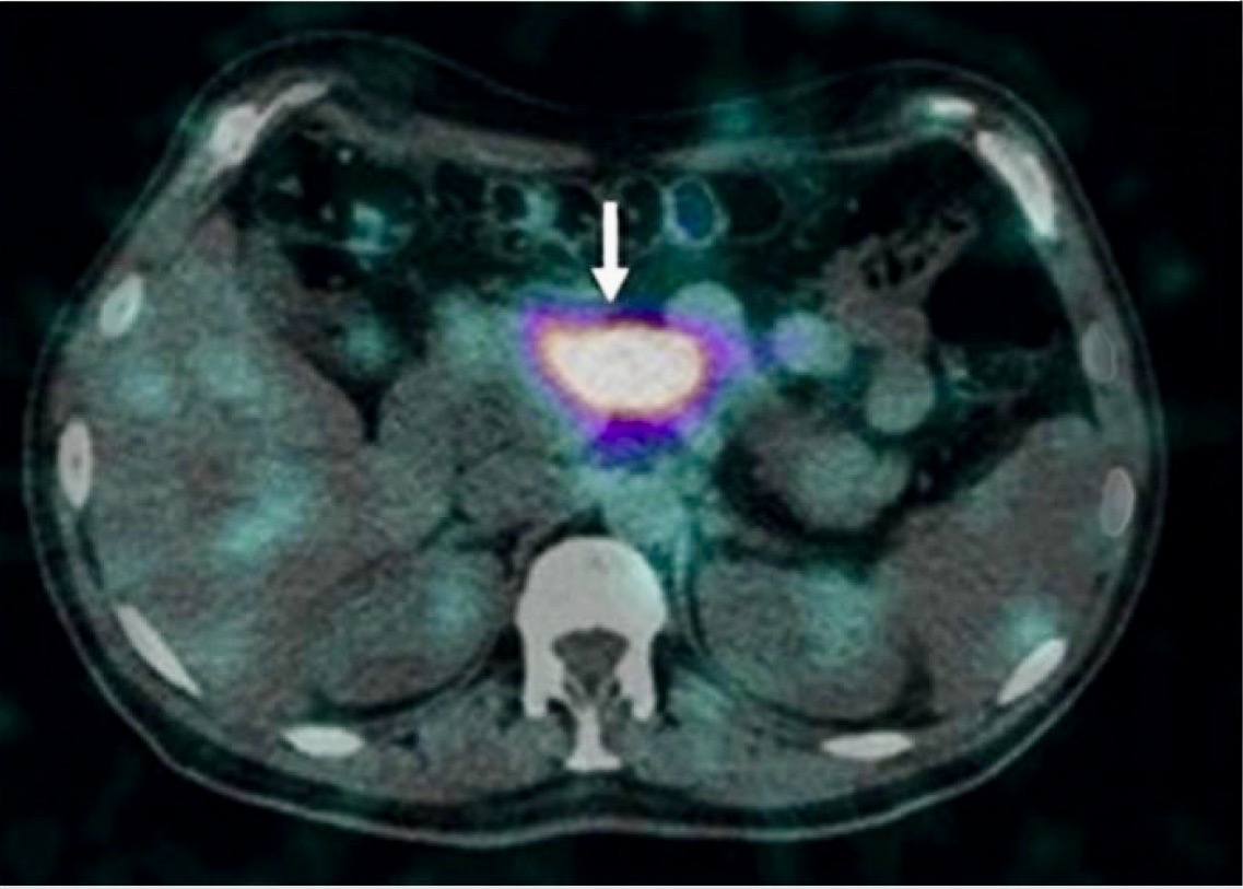 OncoSil™: un trattamento all'avanguardia per il carcinoma pancreatico
