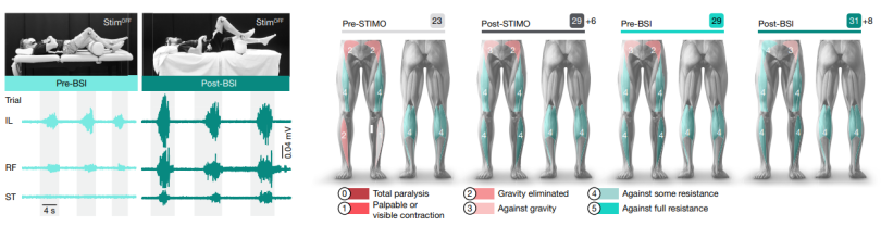 Brain-spine interface: un ponte tra cervello e midollo spinale